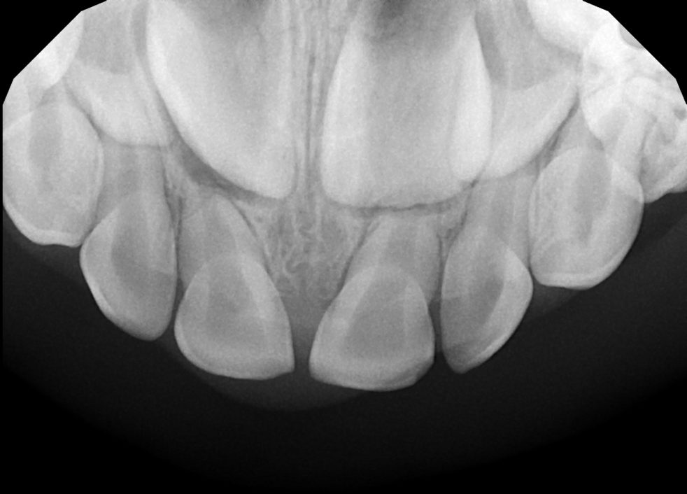 Dental X-Rays: The Whole Tooth – Pediatric Dental Blog