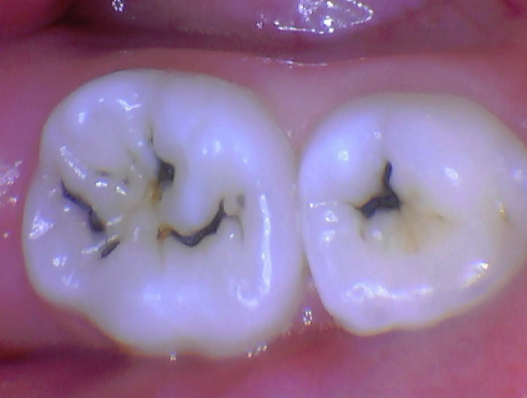 SDF: Pediatric Dentistry’s New Silver Bullet – Pediatric Dental Blog